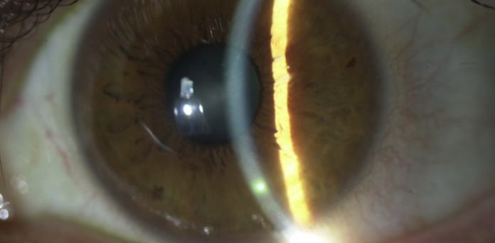 What is the Best Contact Lens to Fit after a Peripheral Corneal Ulcer ...